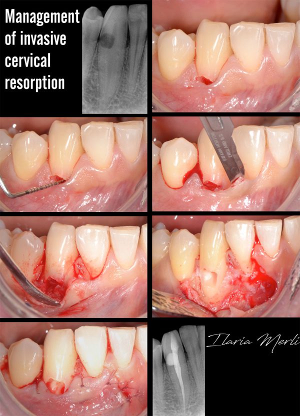Management of an idiopathic external cervical resorption in the ...