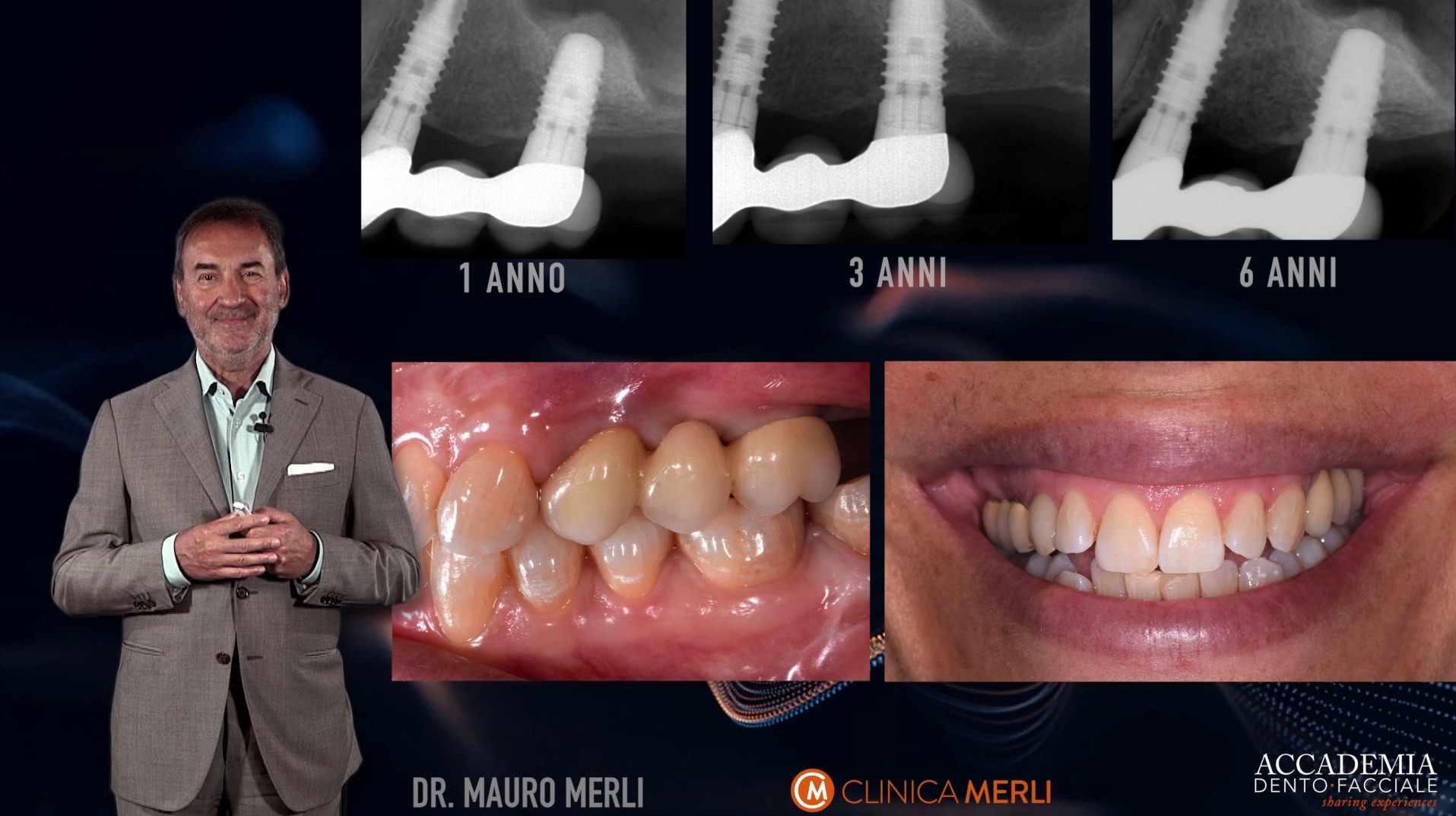 3D Bone Reconstruction using the Fence Technique Procedure - Accademia ...